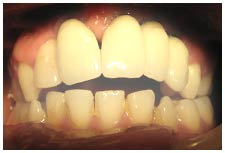 Upper Front Teeth Implants - Aggarwal Dental Clinic