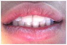 Upper Front Teeth Implants - Aggarwal Dental Clinic