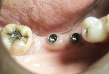 Lower Back Teeth Implants - Aggarwal Dental Clinic