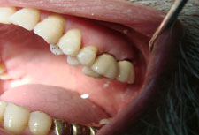 Upper Back Teeth Implants - Aggarwal Dental Clinic