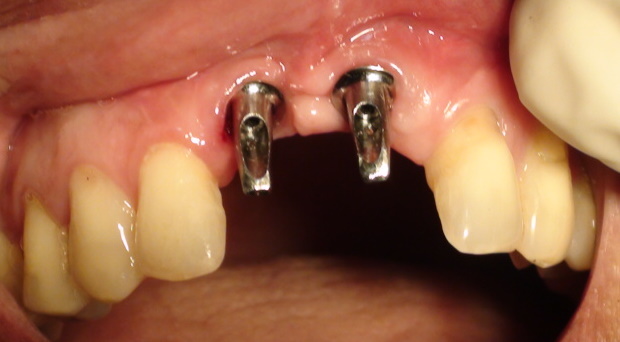 Ankylos Implants for Upper Front Teeth - Aggarwal Dental Clinic
