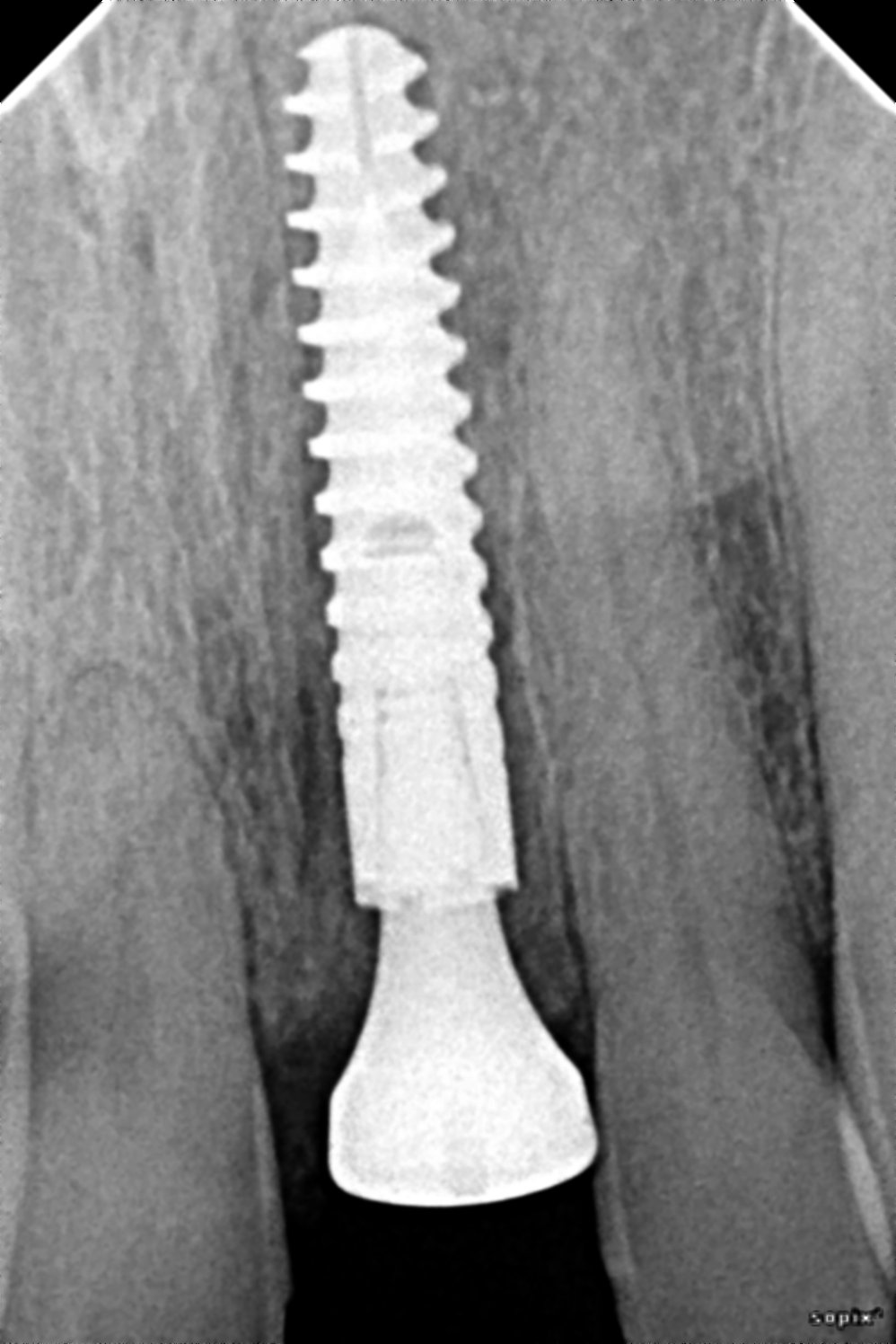 Upper Central Incisor replacement with Ankylos Implant - Aggarwal ...