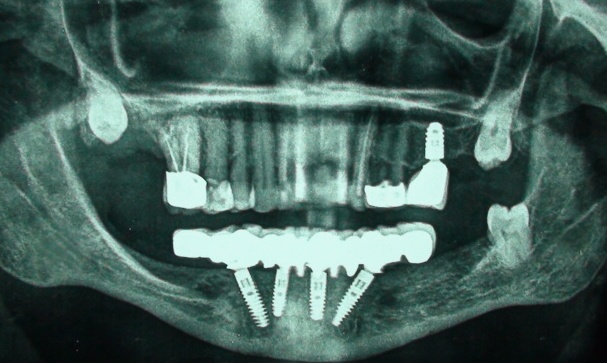 All-ON-4 Implant Bridge on Ankylos Implants - Aggarwal Dental Clinic