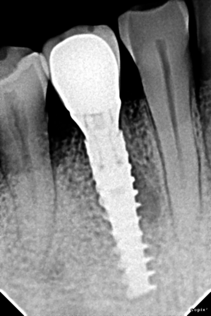 Immediate Loading with Nobel Active - Aggarwal Dental Clinic