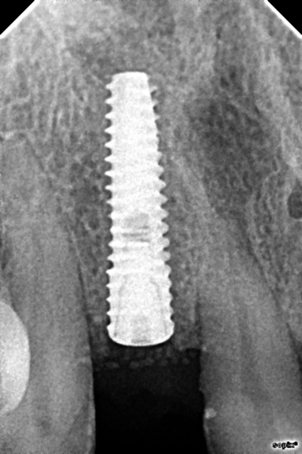 Single Front Tooth Implant at Aggarwal Dental Clinic Jalandhar , India